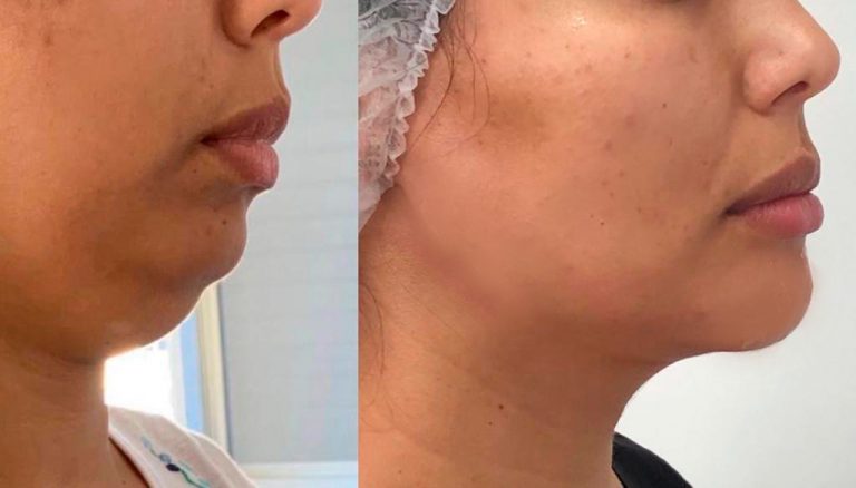 Preenchimento de Mento | Blog - Maíra Platero